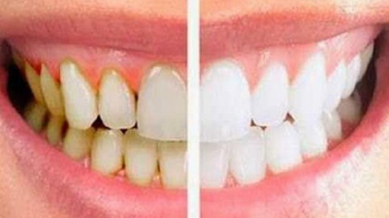 Foto Penyebab Gigi Kuning Dan Cara Mengatasinya